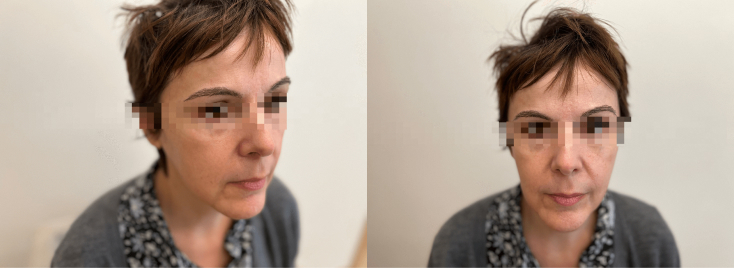 Εμφύτευση Φρυδιών με FUE - Dr. Απόστολος Καραλέξης